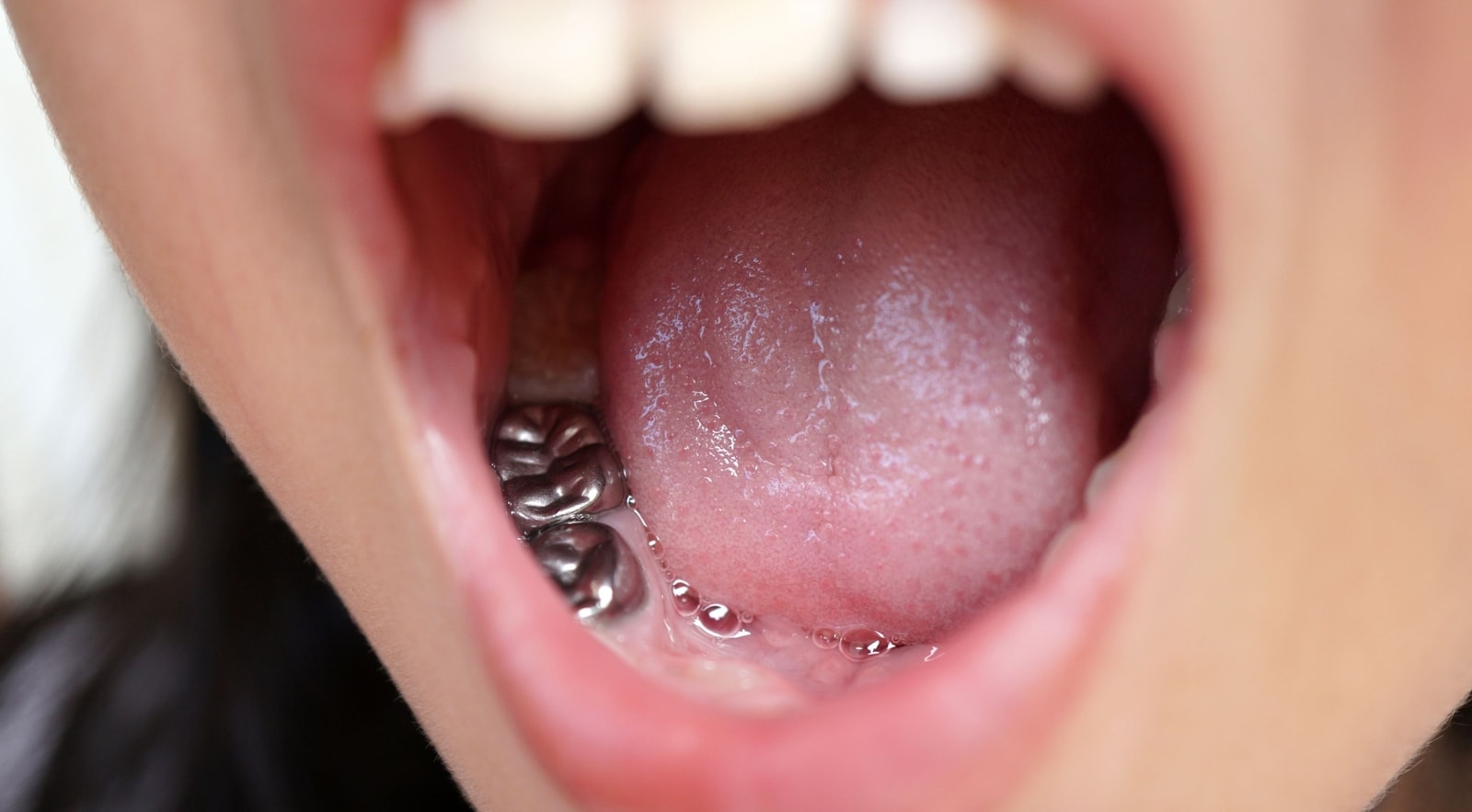 Devya Dental Clinic | Pros and Cons of Various Types of Dental Fillings